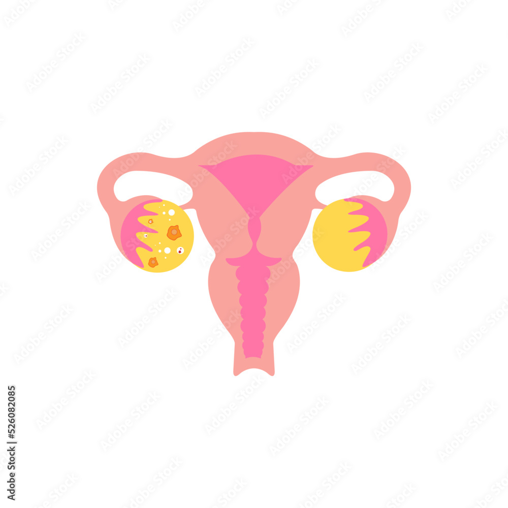 Anatomical drawing. The female uterus and ovaries. Ovarian cyst. Stock ...