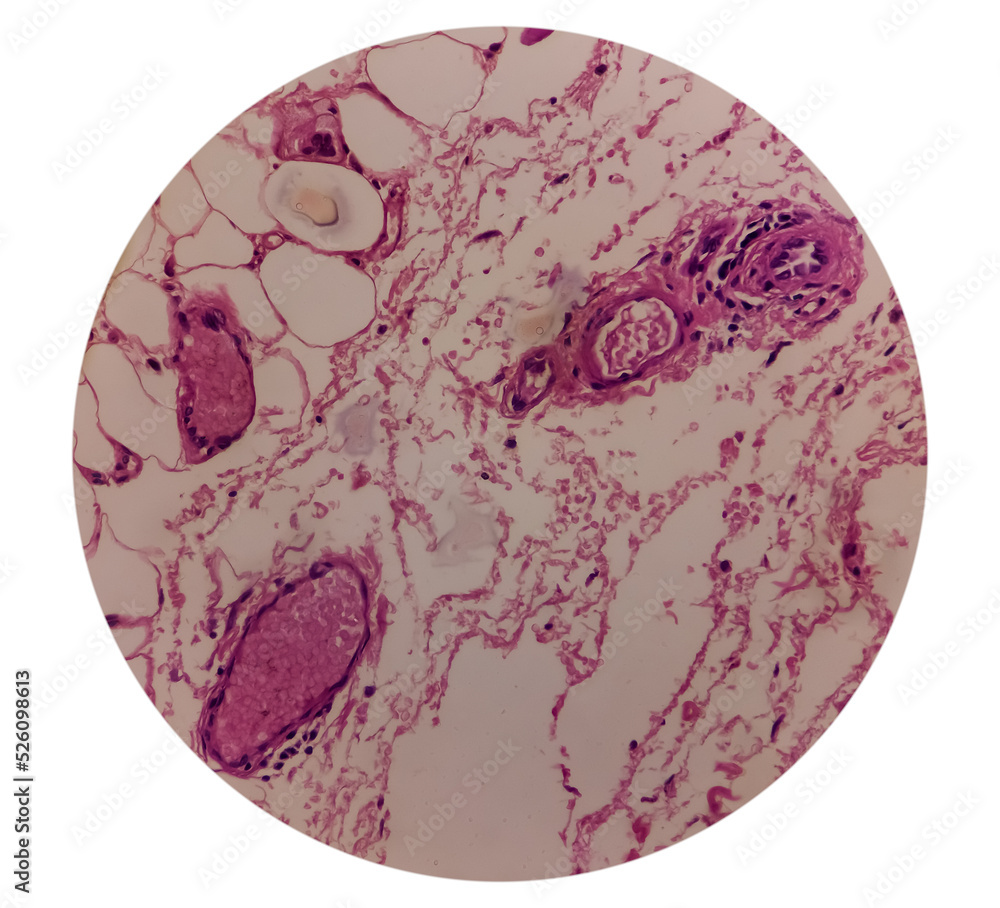 Knee joint(biopsy): Ganglion cells, show microscopic view cyst wall ...
