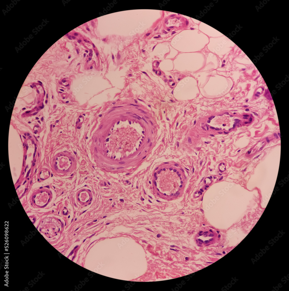 Knee joint(biopsy): Ganglion cells, show microscopic view cyst wall ...