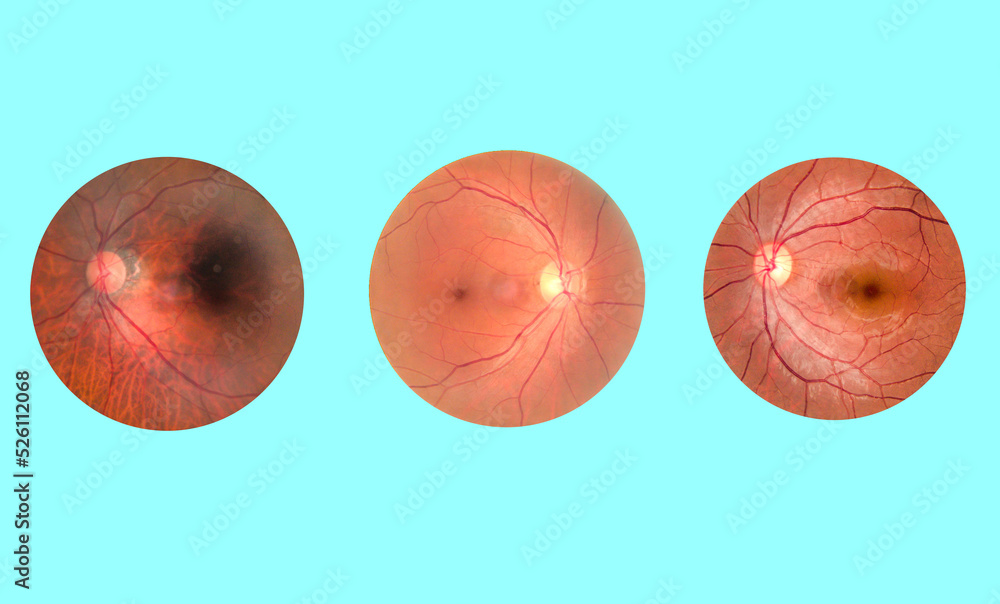 View inside human eye disorders - showing retina, optic nerve and ...