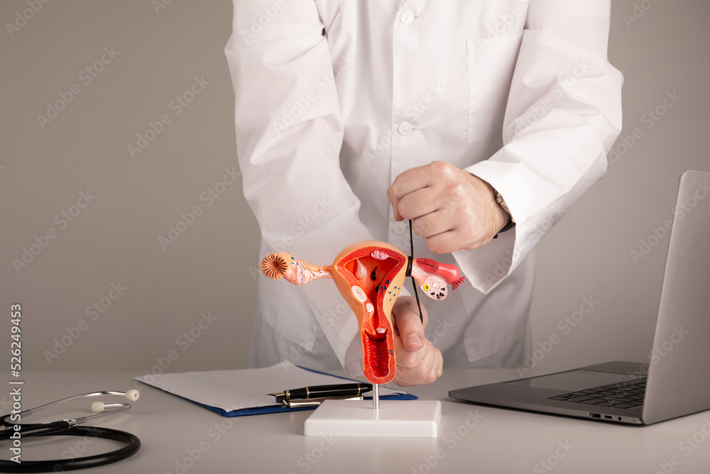 Foto de Gynecologist shows how to ligate the fallopian tubes on ...