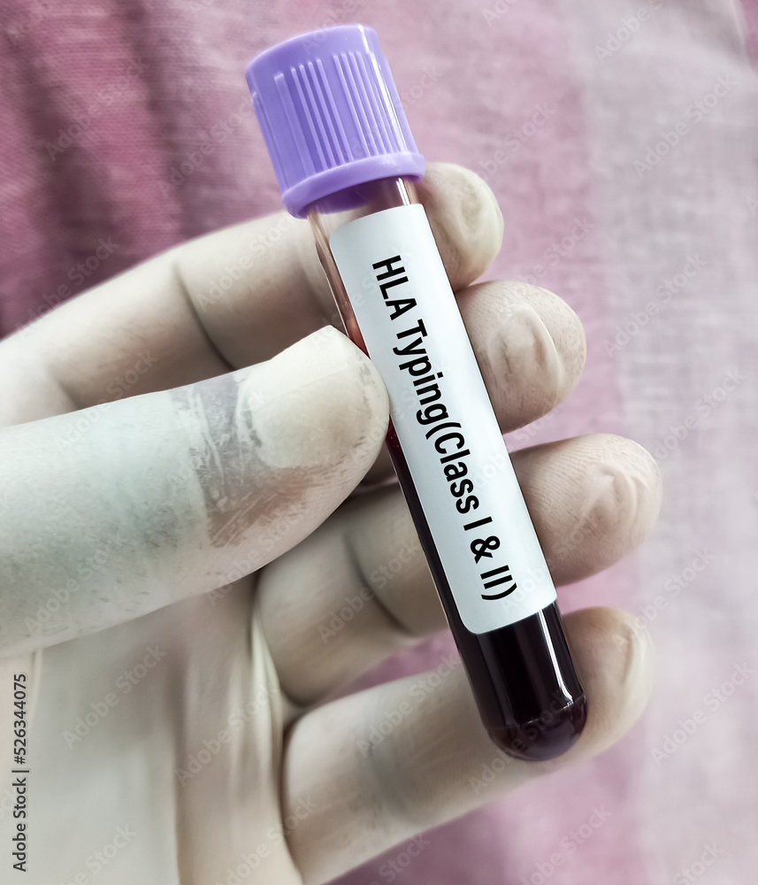 Biologist holding blood sample for HLA(human leukocyte antigen) Typing ...