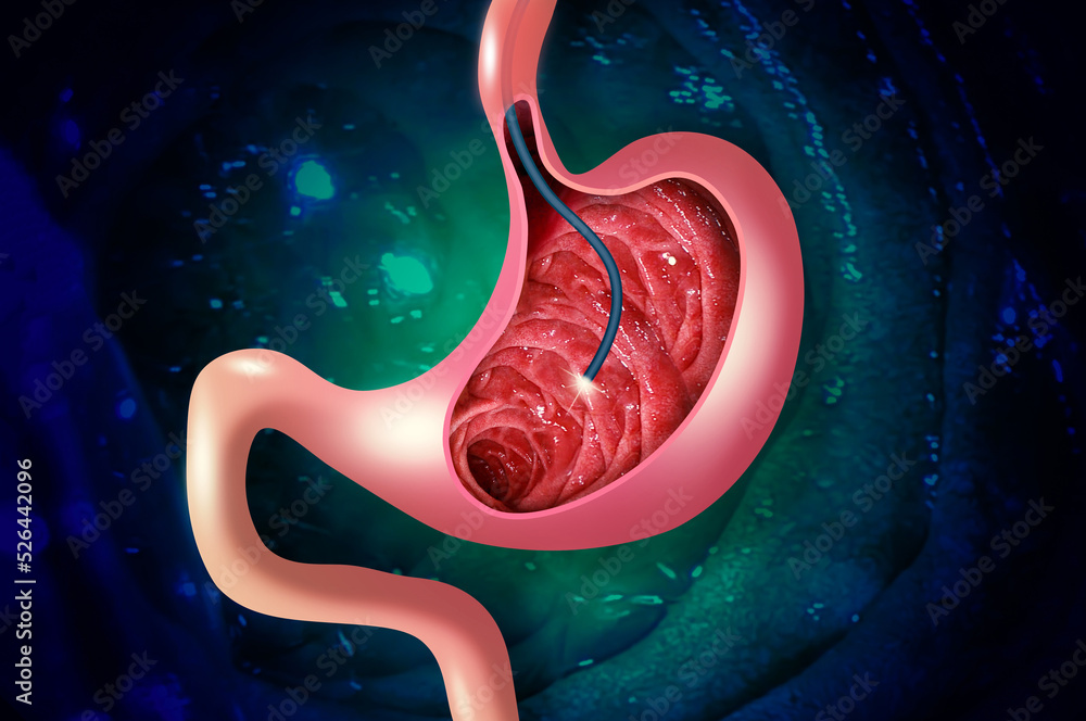 Digestive endoscopy or gastroscopy. Performing a gastroscopy procedure ...