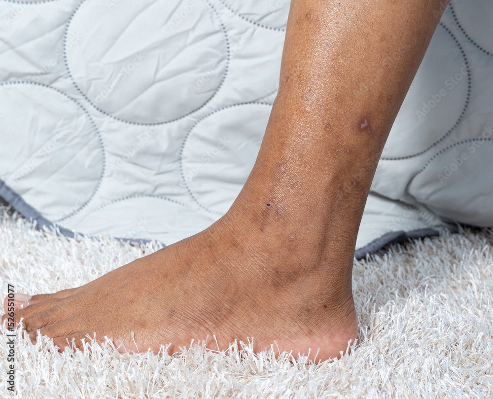 Feet and legs Skin on the feet and legs with scars and dark spots Makes ...