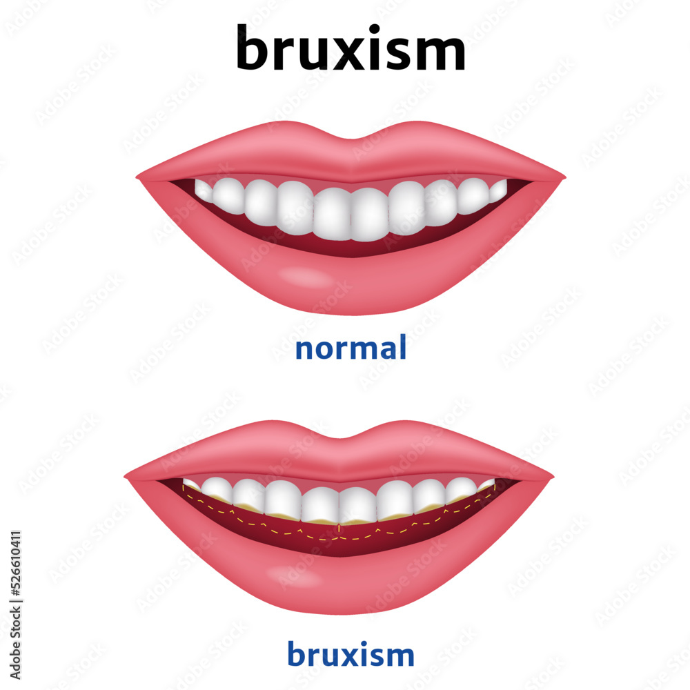 Bruxism. Diagram with worn teeth. Vector illustration Stock Vector ...