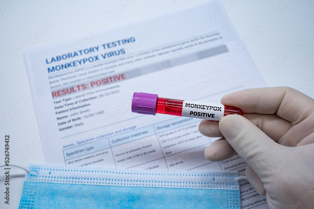 Hand holding blood collection tubes and data sheet on monkeypox test ...
