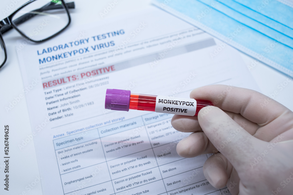 Hand holding blood collection tubes and data sheet on monkeypox test ...