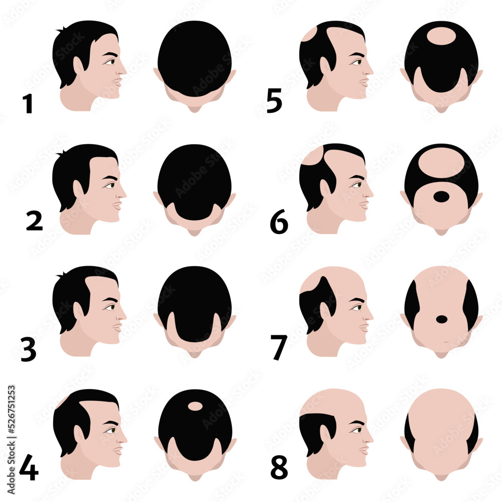 Stages of baldness according to the Norwood scale. Vector flat ...