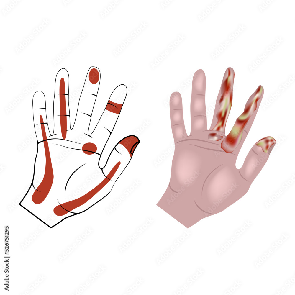 Pyoinflammatory processes of hands and fingers. Infographic with ...