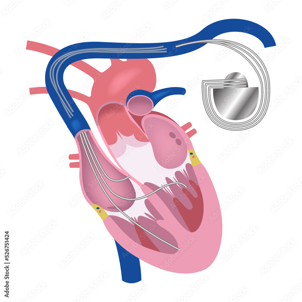 Vetor de Pacemaker. Heart in longitudinal section. Vector medical illustration do Stock | Adobe ...