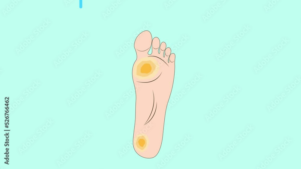 Wart verrucas plantar. Fasciitis Wart on foot. Decease on foot skin ...