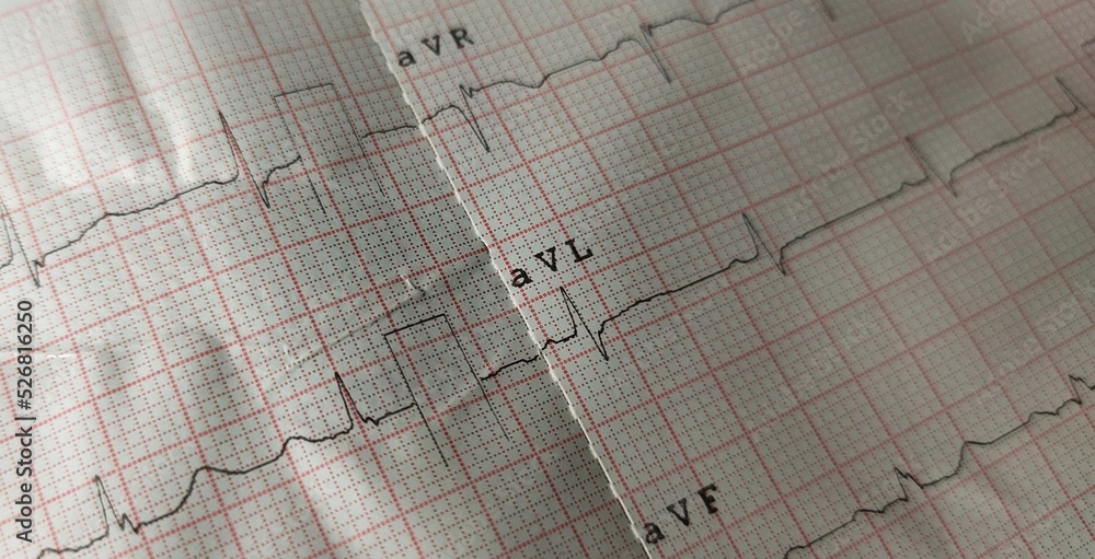 Test record of electrocardiogram (ECG or EKG) heart beat rate or rhythm ...