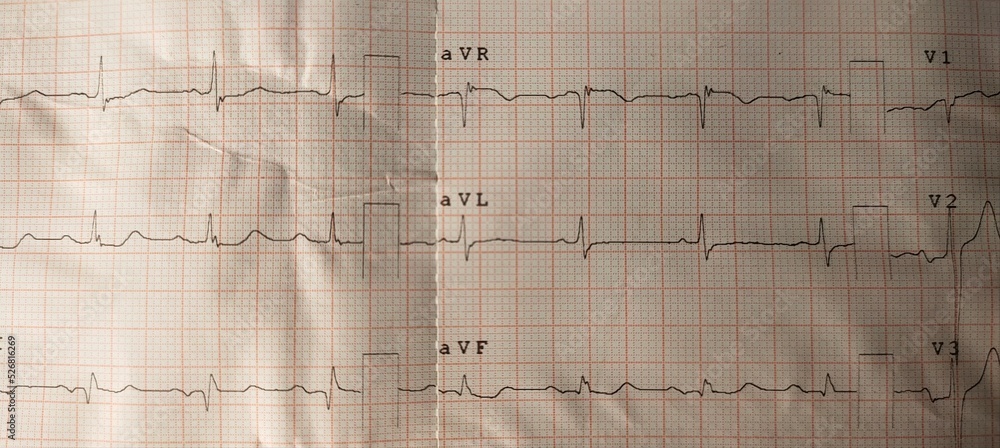 Test record of electrocardiogram (ECG or EKG) heart beat rate or rhythm ...