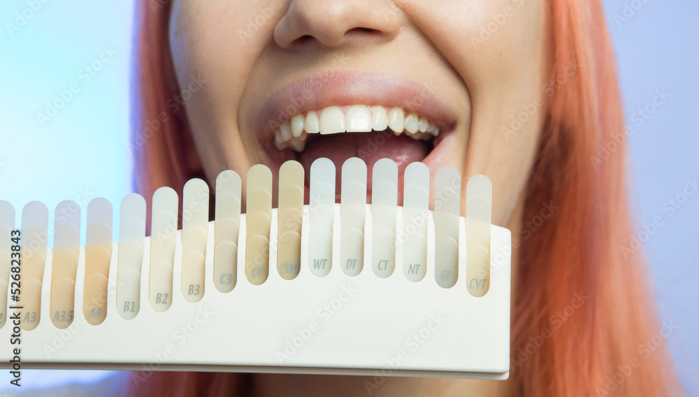 Dentist selects material for prosthetics. Installation of veneers ...