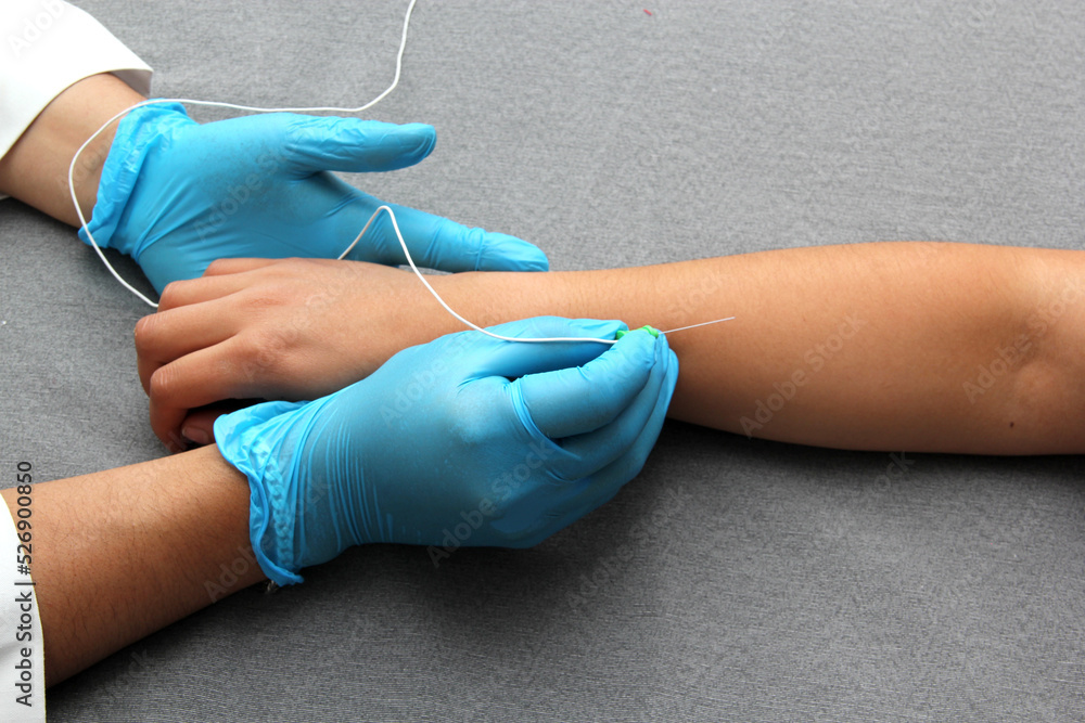 Electromyography is a graphic recording technique of the electrical ...