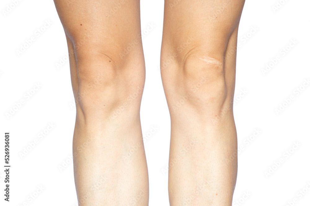 Women's legs with a scar on her knees on a white background, photo ...