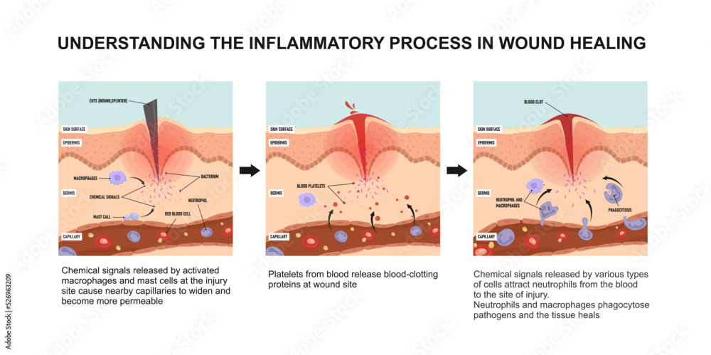 Understanding the inflammatory process in wound healing Stock Vector ...