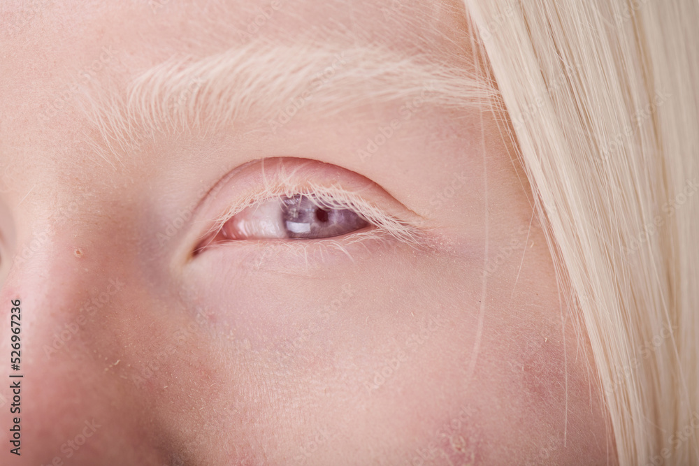 Close-up of young face of albino girl with blue eyes and white ...