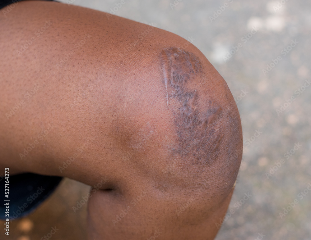 Healed knee of an african Nigerian person with scars markings gotten ...