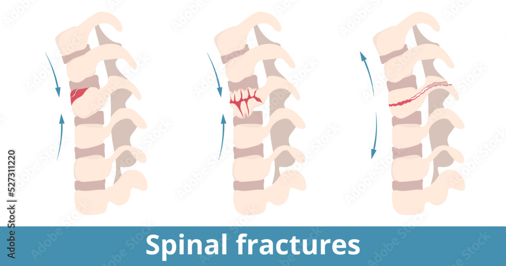 Spinal fractures. Types of spinal fractures depend on damage direction ...