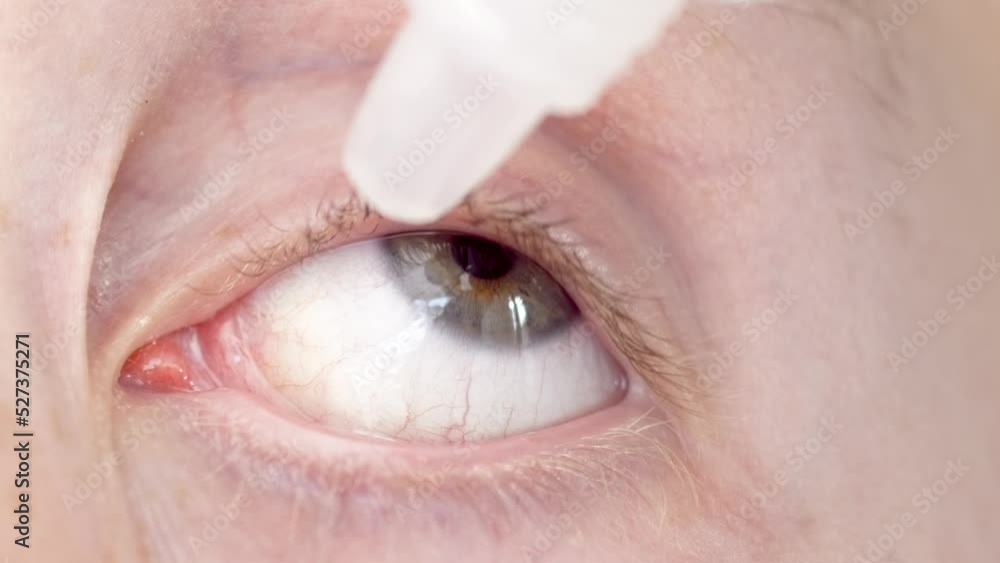 Closeup girl drops eye drops install lenses, moisturizing, using ...