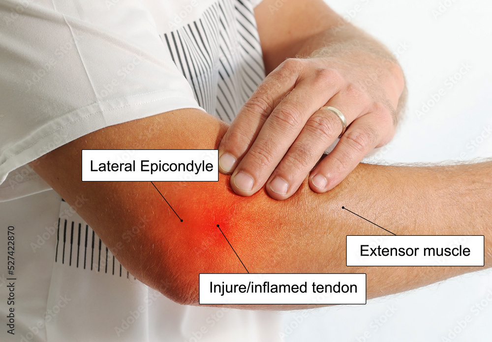 Chart explanation of lateral Epicondylitis or tennis elbow problem in ...