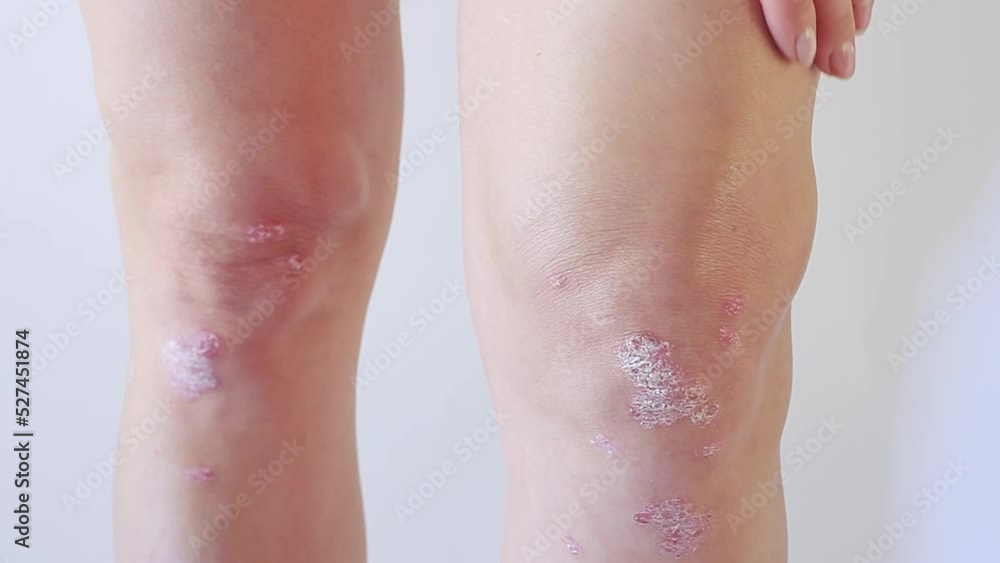 Psoriatic Arthritis With Skin Psoriasis On A Womans Knees Inflammatory Arthritis Causing