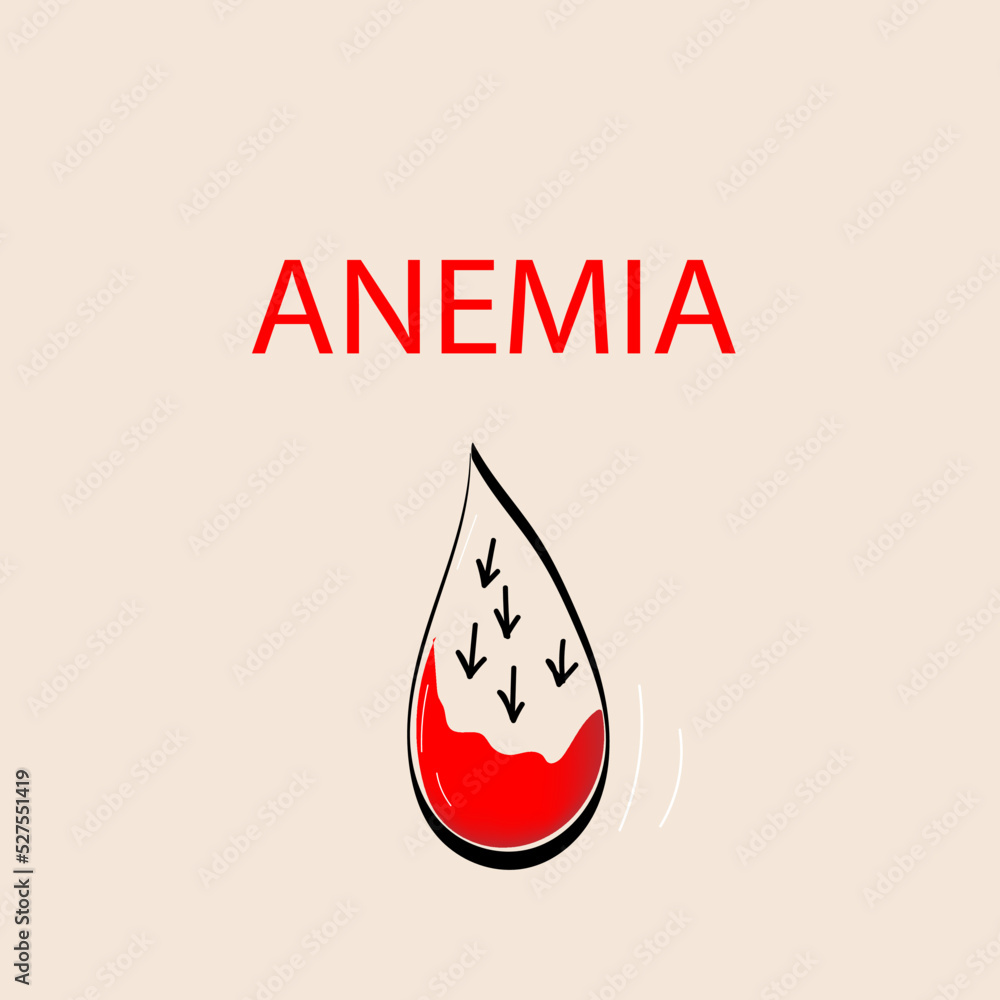 Drop of blood with a low hemoglobin content. Hypoglycemia and anemia ...