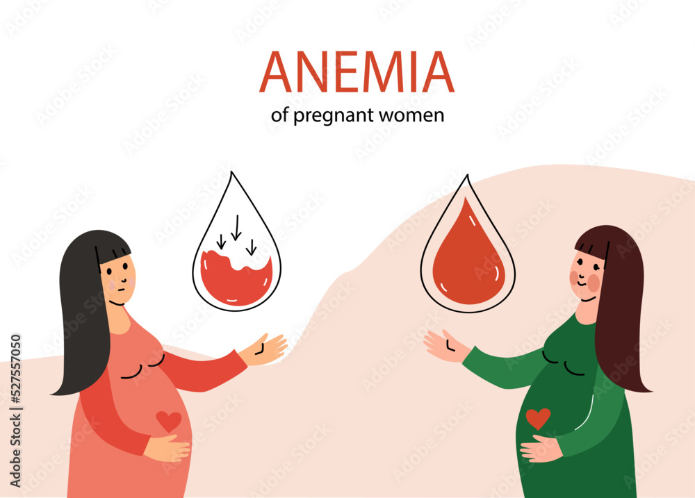 Anemia concept. Pregnant woman suffering from anemia. Low hemoglobin ...