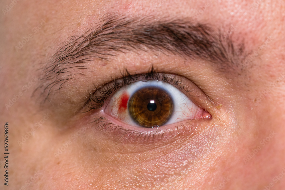 Eye injury, young man with burst blood vessel in eye, fatigue, problems ...
