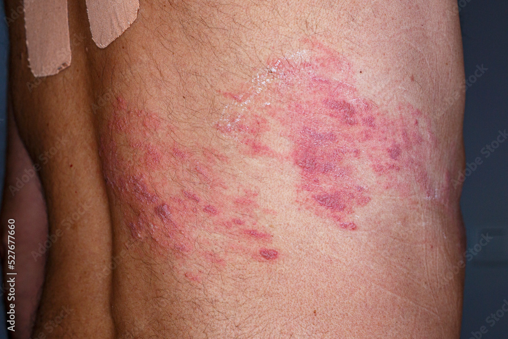 Skin lesion symptom in Shingles or Herpes zoster in human. Shingles or ...