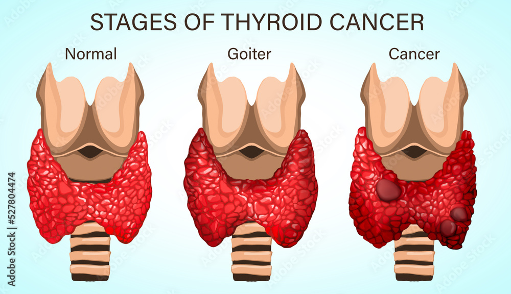 Set with illustration of healthy and diseased thyroid on light ...