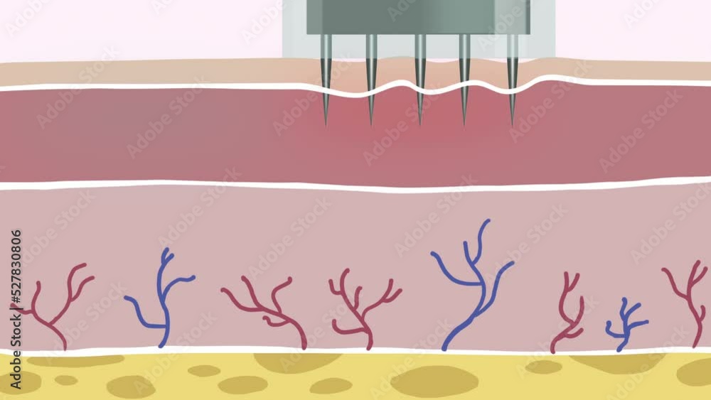 Microneedling Collagen Induction Therapy, 4k flat animation, pen ...