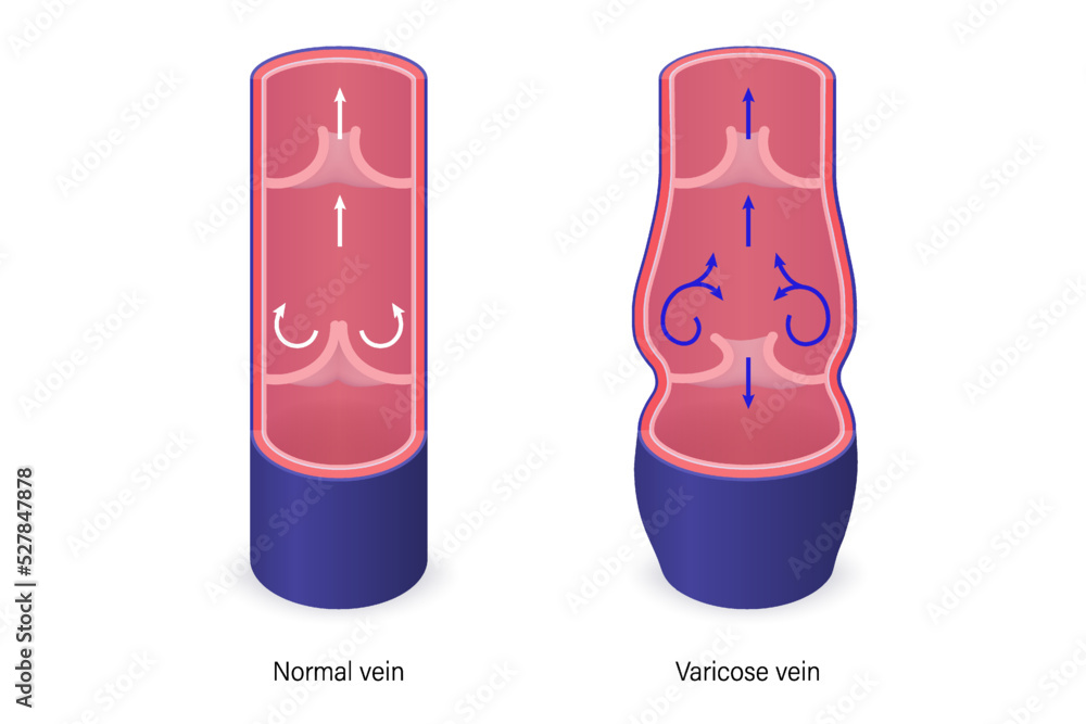Varicose vein vector. The difference of normal vein and varicose vein ...