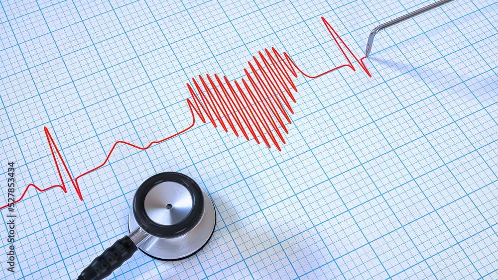 Heartbeat electrocardiograph and stethoscope on ECG or EKG paper. Heart ...