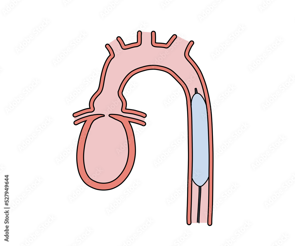 IABP（大動脈内バルーンパンピング術） 素材庫插圖 | Adobe Stock