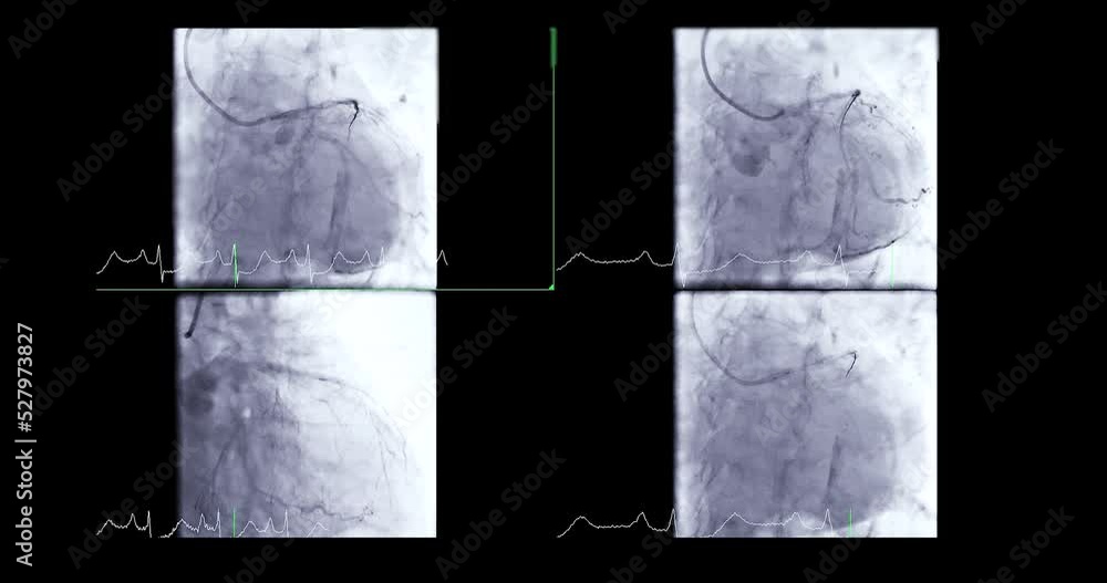 Coronary angiogram of coronary artery during cardiac catheterization in ...