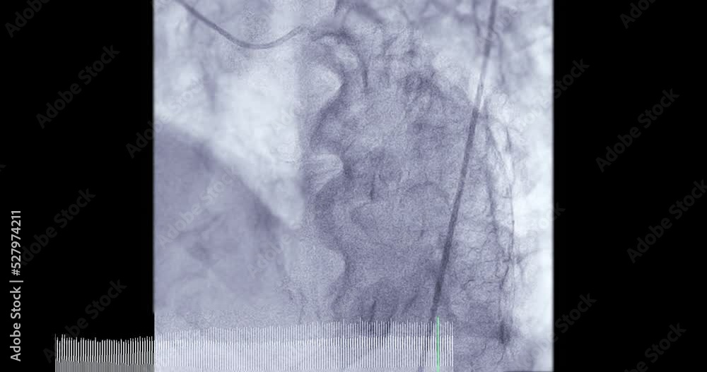 Coronary angiogram of coronary artery during cardiac catheterization in ...