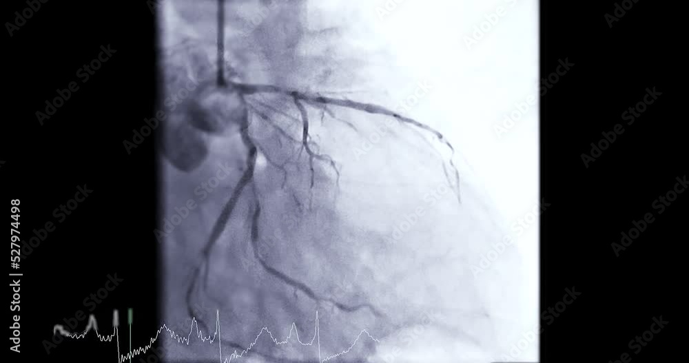 Video Stock Coronary angiogram of coronary artery during cardiac ...