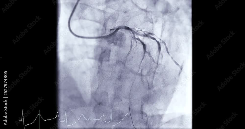 Coronary angiogram of coronary artery during cardiac catheterization in ...