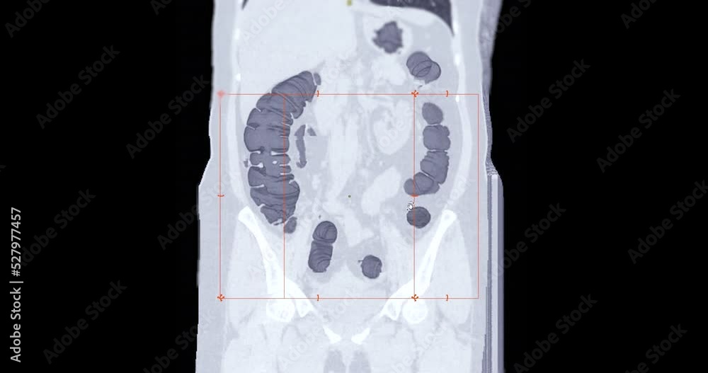 CT colonography or CT Scan of large intestine 3D rendering on the ... CT colonography or CT Scan of large intestine 3D rendering on the ...