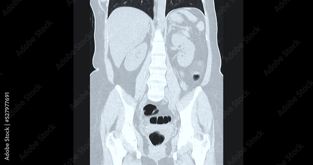 Vidéo Stock CT colonography or CT Scan of large intestine 3D rendering ...
