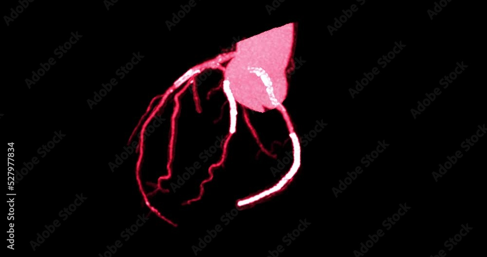 CTA Coronary artery 3D rendering image s detect coronary artery disease ...