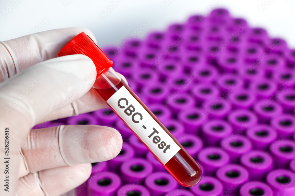 CBC test for abnormalities in red blood cells, Blood samples to be ...