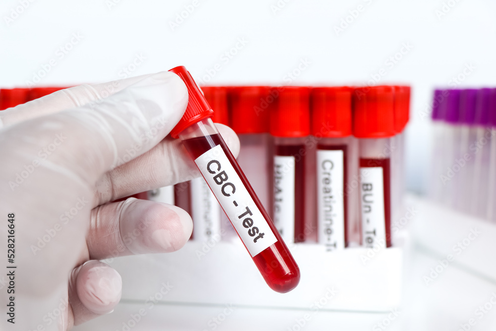 CBC test for abnormalities in red blood cells, Blood samples to be ...