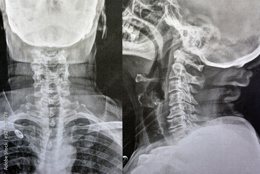 Plain X ray cervical vertebrae showing straightening of cervical ...
