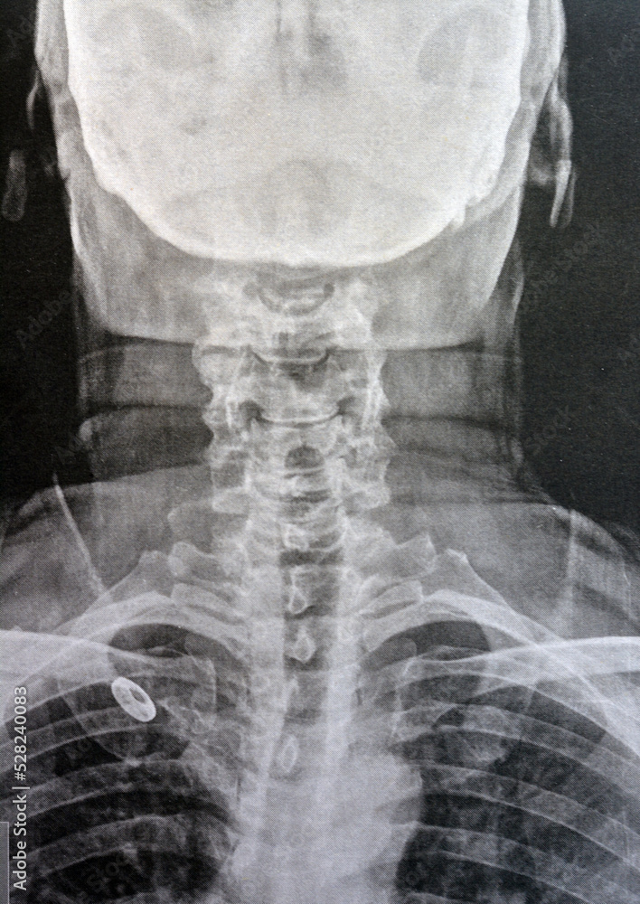 Plain X ray cervical vertebrae showing straightening of cervical ...
