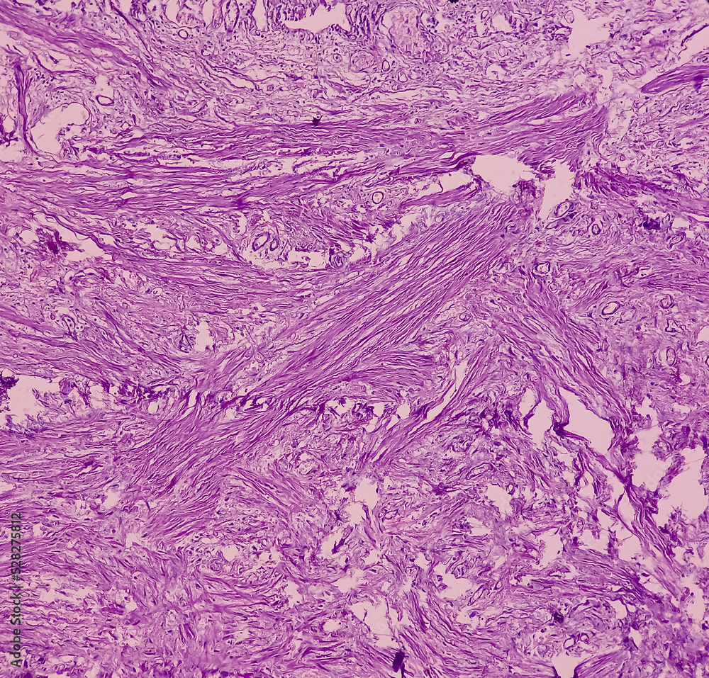 Suppurative Cholecystitis Of Gallbladder Show Perimuscular Fibrosis