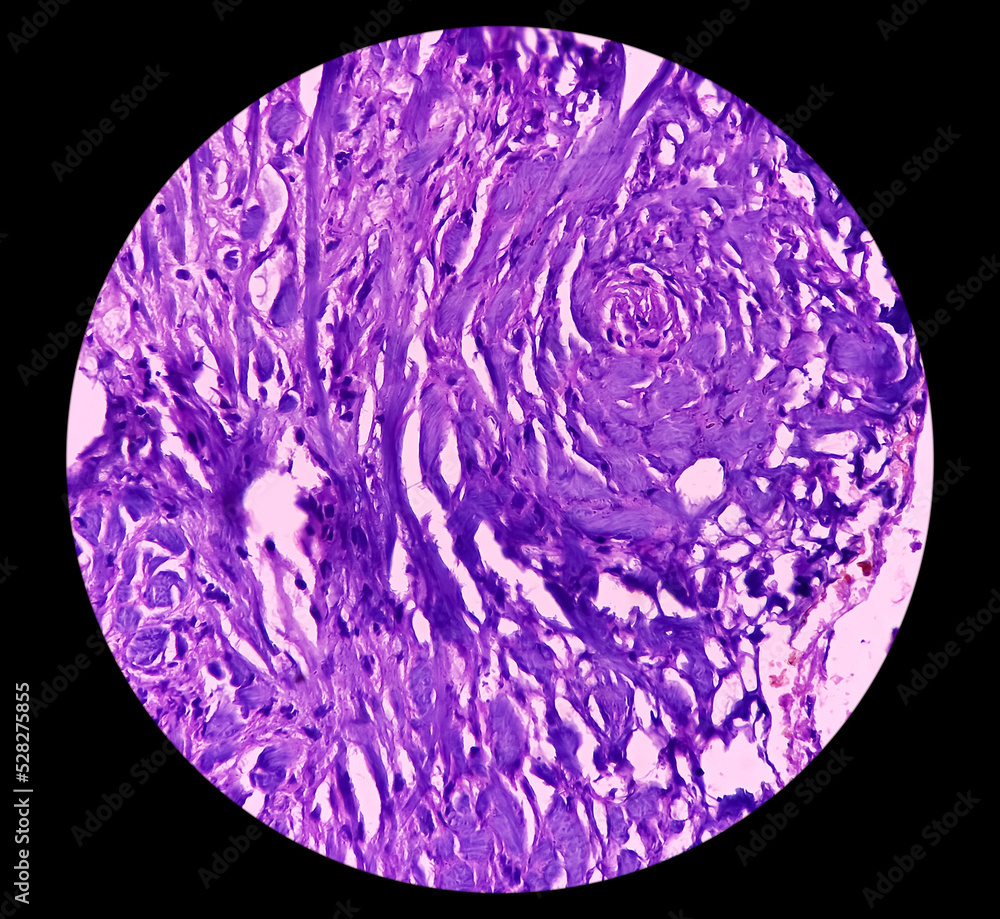 Suppurative Cholecystitis Of Gallbladder Show Perimuscular Fibrosis And Dense Infiltration Of