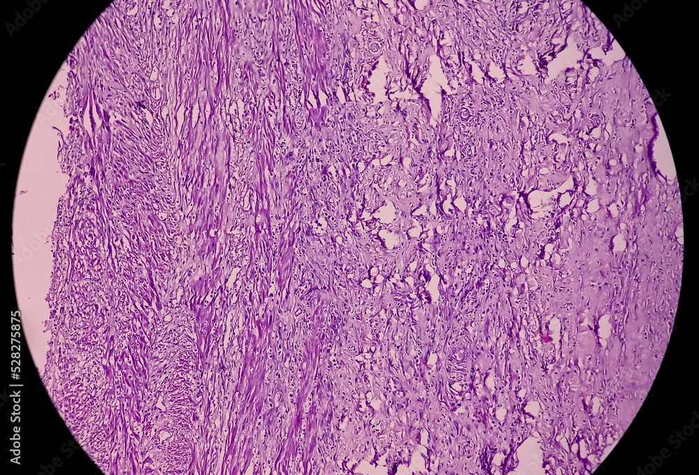 Suppurative cholecystitis of Gallbladder, show perimuscular fibrosis ...
